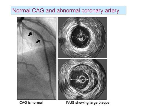 What is a normal coronary angiogram & What is a normal coronary artery ...