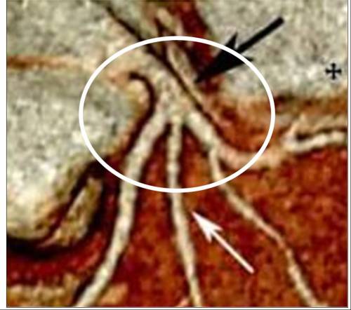 What is the clinical significance of ramus intermedius coronary artery ...