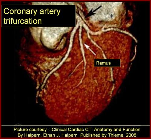 What is the clinical significance of ramus intermedius coronary artery ...