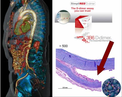 d dimer | Dr.S.Venkatesan MD