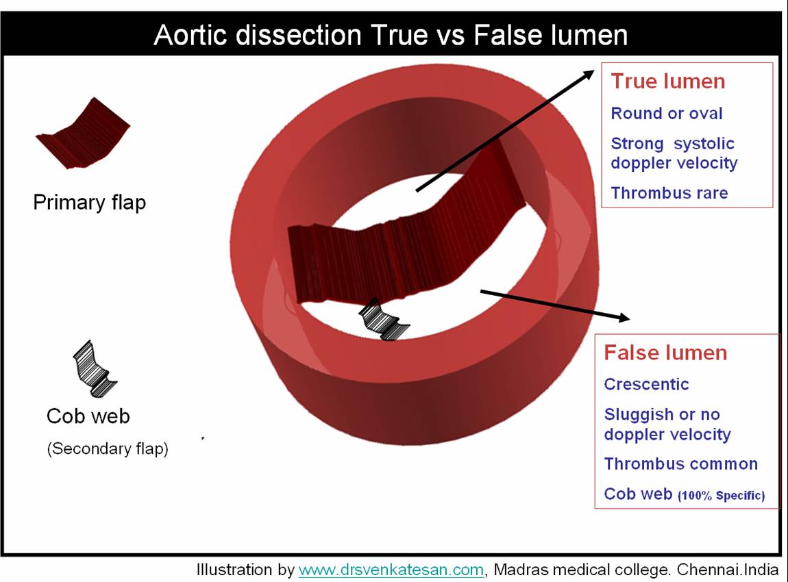 aortic-dissection-4 | Dr.S.Venkatesan MD