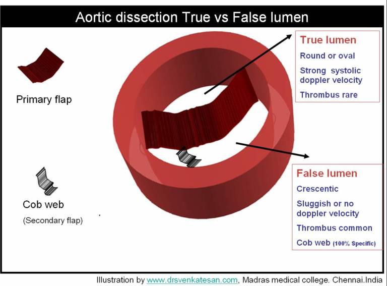 The Aortic dissection : What you wanted to know about true and false ...