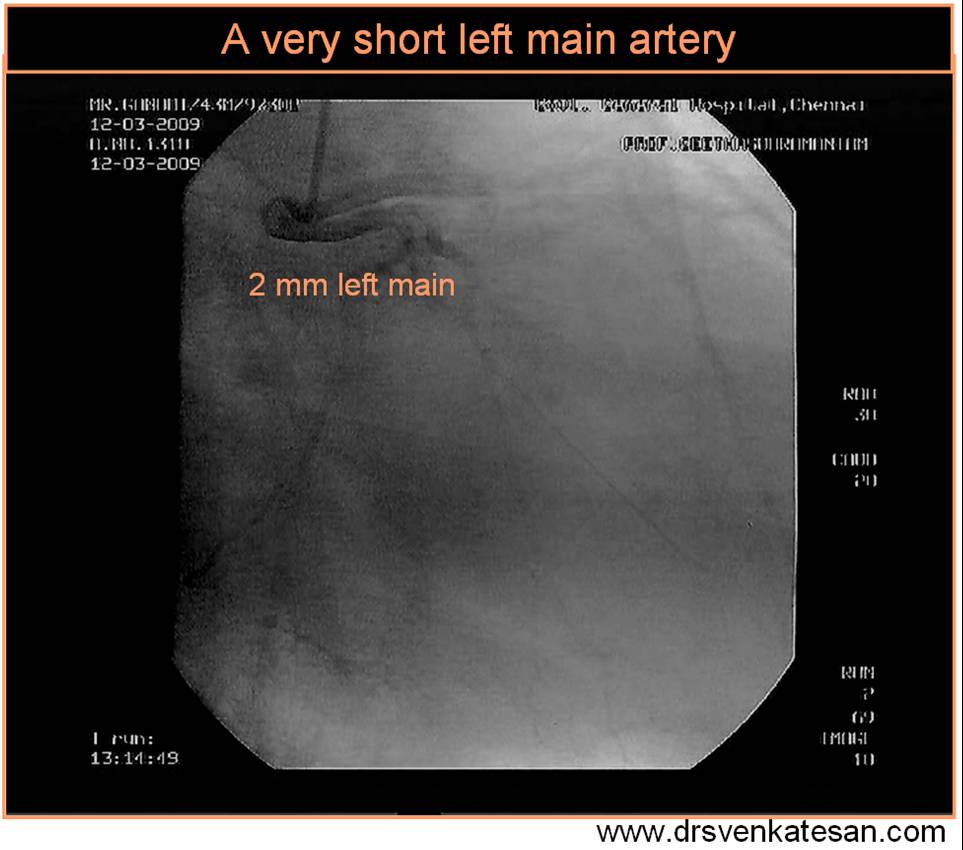 left-main-3 | Dr.S.Venkatesan MD