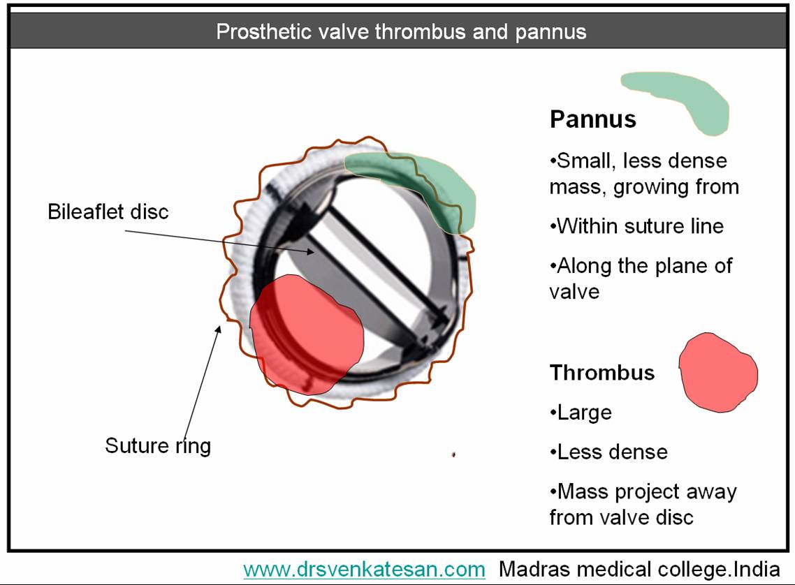 What is pannus formation in prosthetic valves ? What is the clinical ...