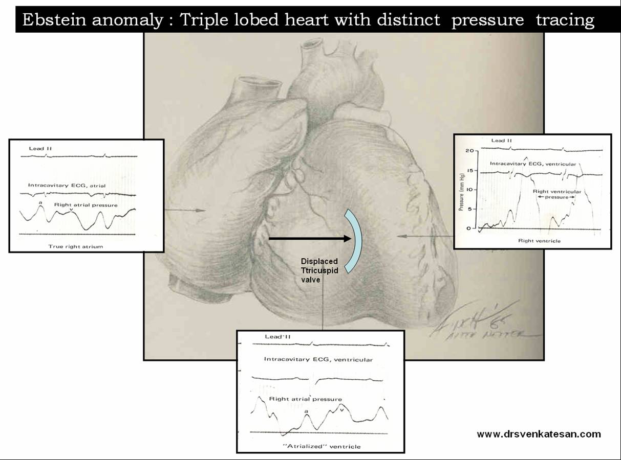 Ebstein anomaly :An illustration with pressure tracing | Dr.S.Venkatesan MD