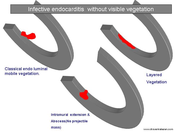 native valve endocarditis | Dr.S.Venkatesan MD