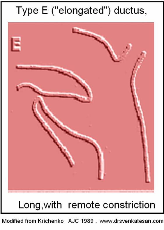 What is the size of patent ductus ? How do you classify patent ductus ...