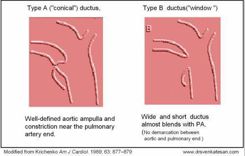 What is the size of patent ductus ? How do you classify patent ductus ...