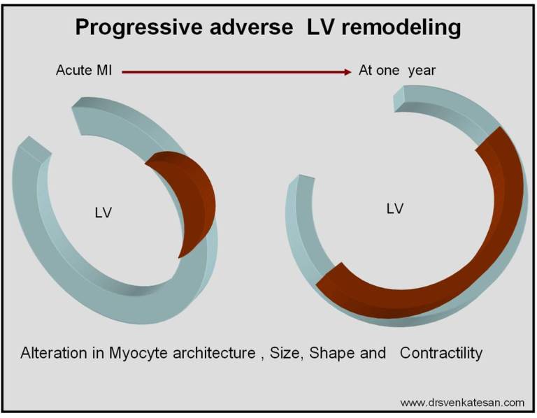 lv-remodeling | Dr.S.Venkatesan MD