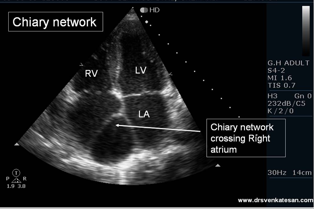 The “not so” benign chiary network | Dr.S.Venkatesan MD