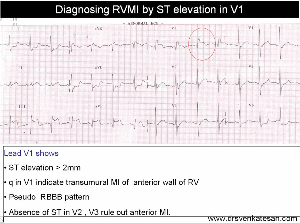walls of rv | Dr.S.Venkatesan MD