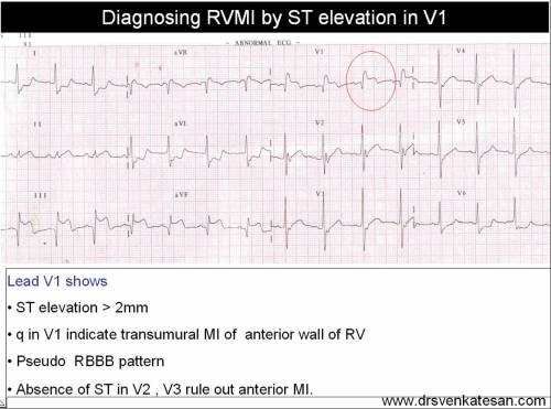 right ventricle | Dr.S.Venkatesan MD