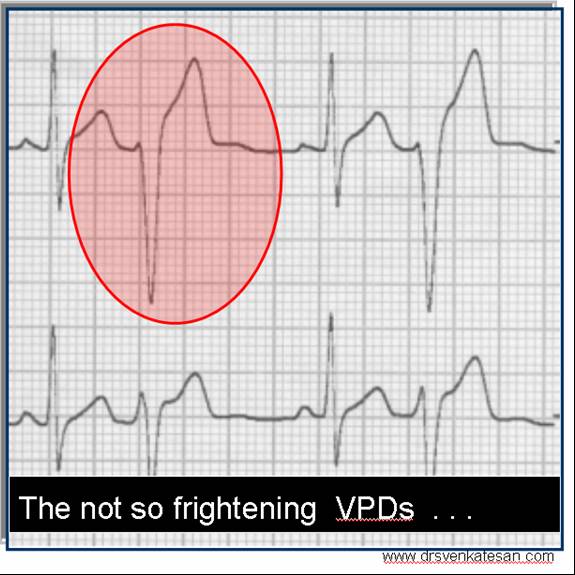 3 minutes crash course on ventricular ectopic beats (VPDs) | Dr.S ...