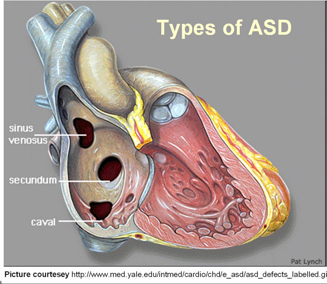Unusual Atrial septal defects : Sinus venosus type of ASD . | Dr.S ...