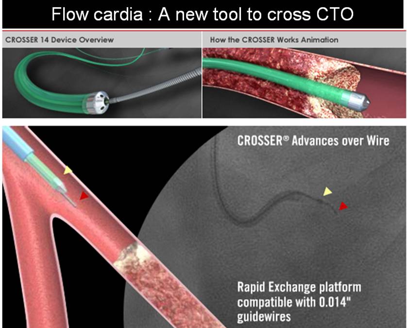 How to tunnel your way into the CTO and create your own coronary artery ...
