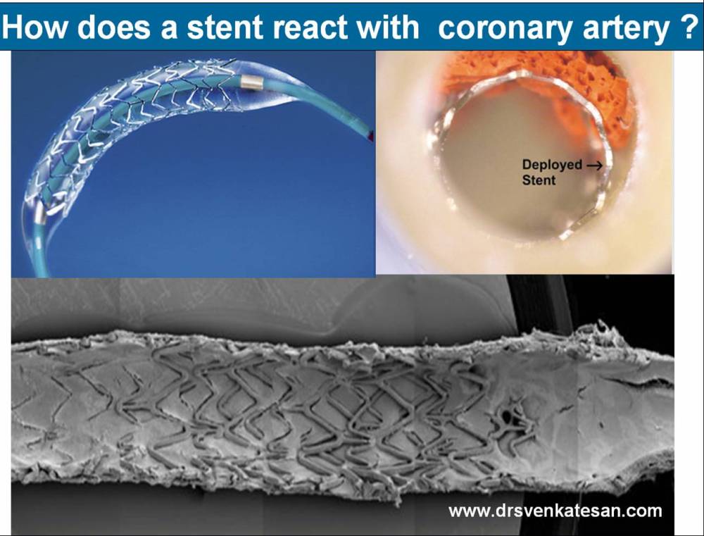 pci stent coronary angiogram thrombosis des | Dr.S.Venkatesan MD