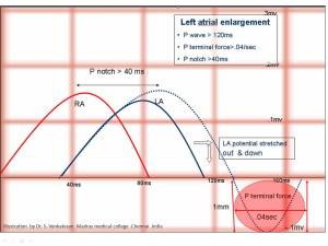 right and left atrial enlargement how to differentiate lae rae | Dr.S ...