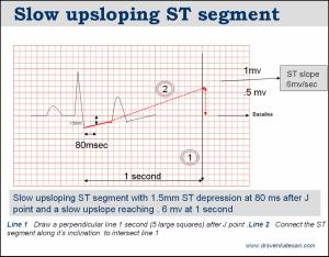 What is up sloping ST depression ? How do you measure it ? What is the ...