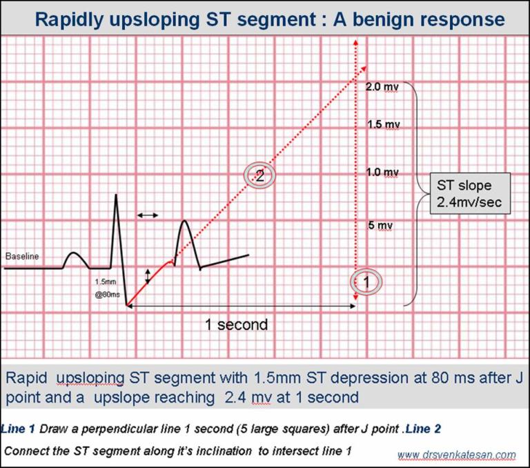 upsloping st segment tmt st slope ecg | Dr.S.Venkatesan MD