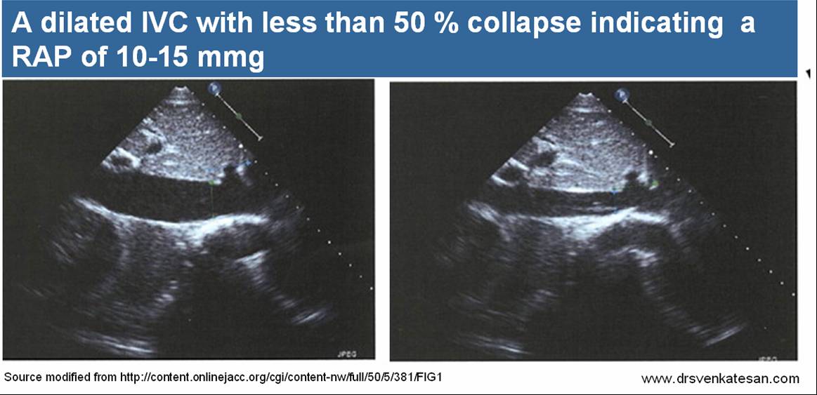 ivc collapse ra pressure right atrial mean pressure | Dr.S.Venkatesan MD