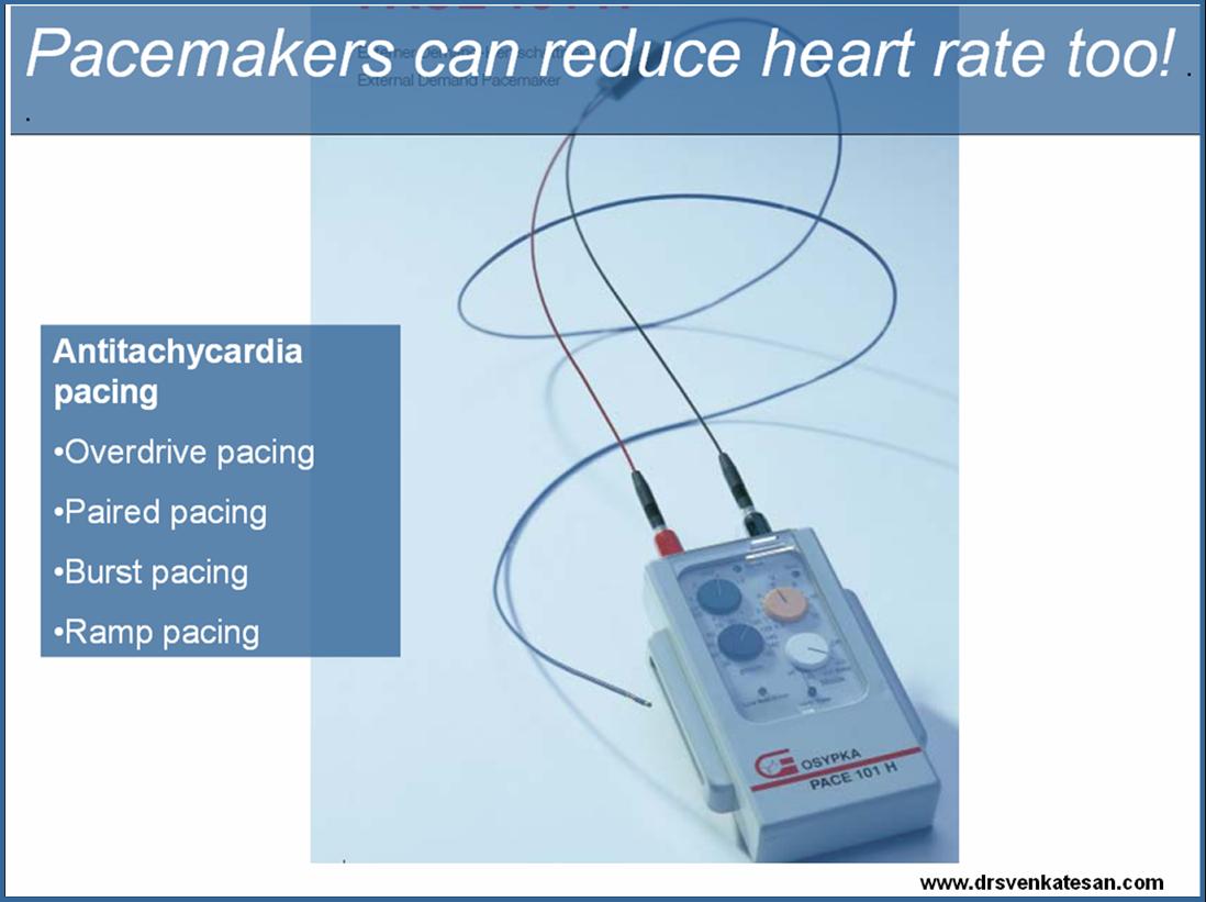 ramp pacing | Dr.S.Venkatesan MD