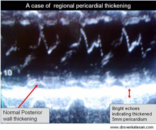 Beware of non infarct q waves : A women with an unusual pathological q ...