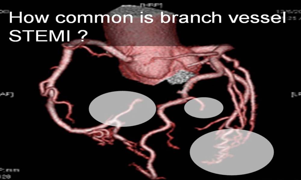 What is branch vessel STEMI ? How common it is , among STEMI population ...