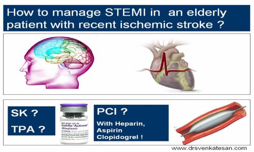 stroke in evolution | Dr.S.Venkatesan MD