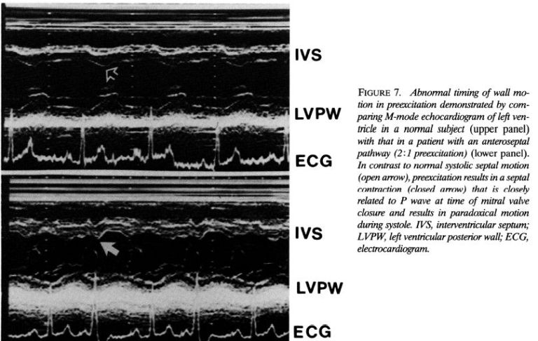 echocardiography in wpw syndrome | Dr.S.Venkatesan MD