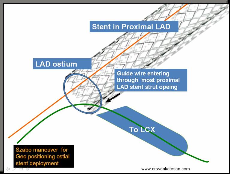 Tackling ostial LAD lesions : A new technique | Dr.S.Venkatesan MD