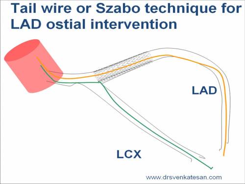 Tackling ostial LAD lesions : A new technique | Dr.S.Venkatesan MD