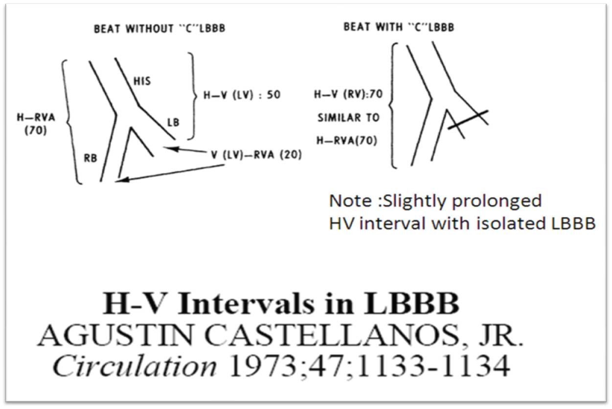 lbbb hv interval | Dr.S.Venkatesan MD