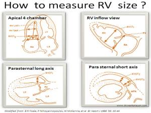 What is the normal RV size ? How to measure it by echocardiography ...