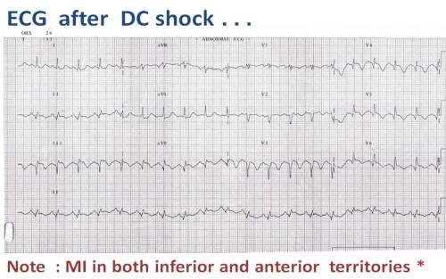 scar induced vt | Dr.S.Venkatesan MD