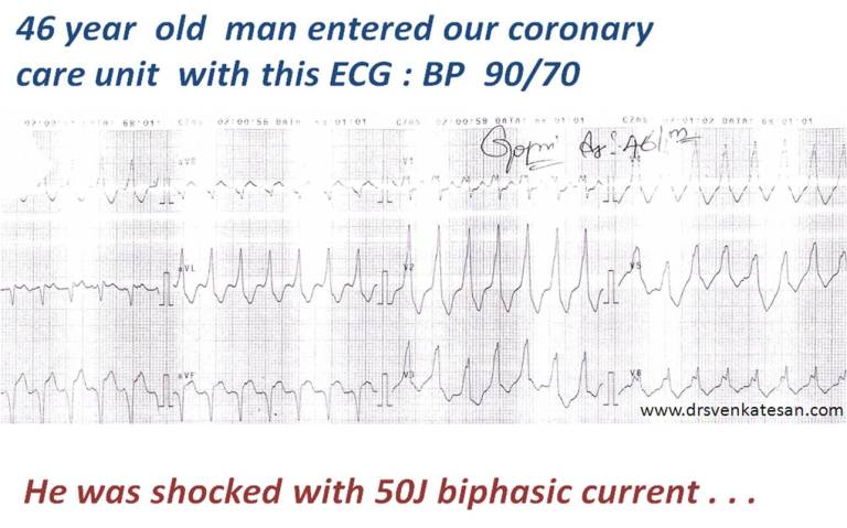 scar induced vt | Dr.S.Venkatesan MD