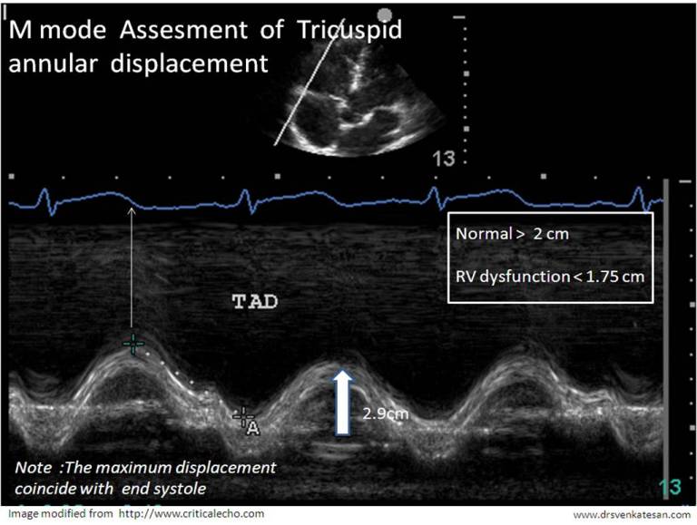 rv function assessment | Dr.S.Venkatesan MD
