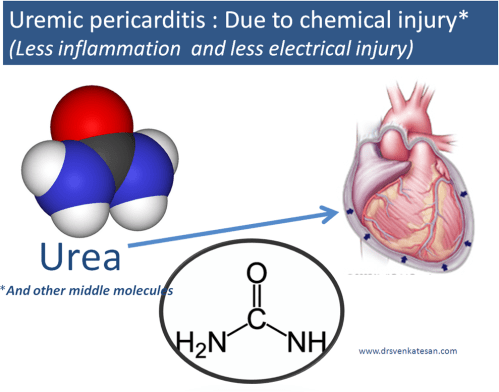 ecg changes in uremic pericarditis | Dr.S.Venkatesan MD