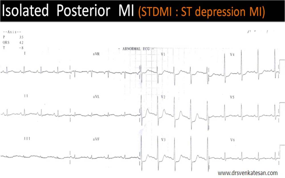 posterior stemi | Dr.S.Venkatesan MD