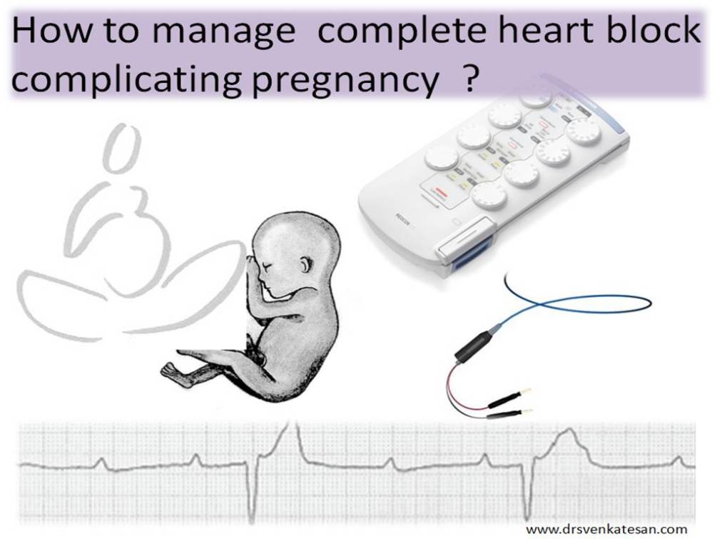 How to manage complete heart block during pregnancy ? | Dr.S.Venkatesan MD