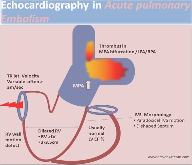echocardiography of pulmoanry embolism | Dr.S.Venkatesan MD