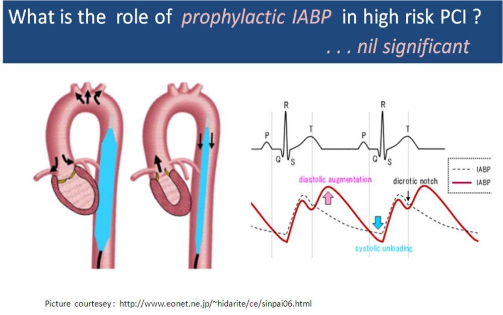 Cath lab teasers : Routine prophylactic IABP does nothing ! | Dr.S ...