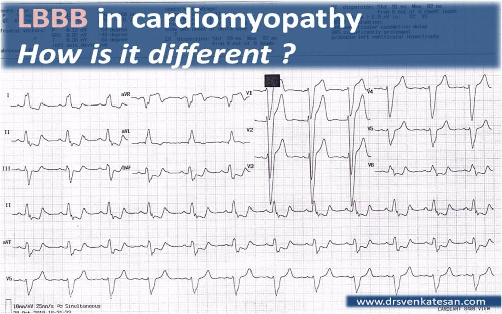 Organic vs Benign Left bundle branch block | Dr.S.Venkatesan MD