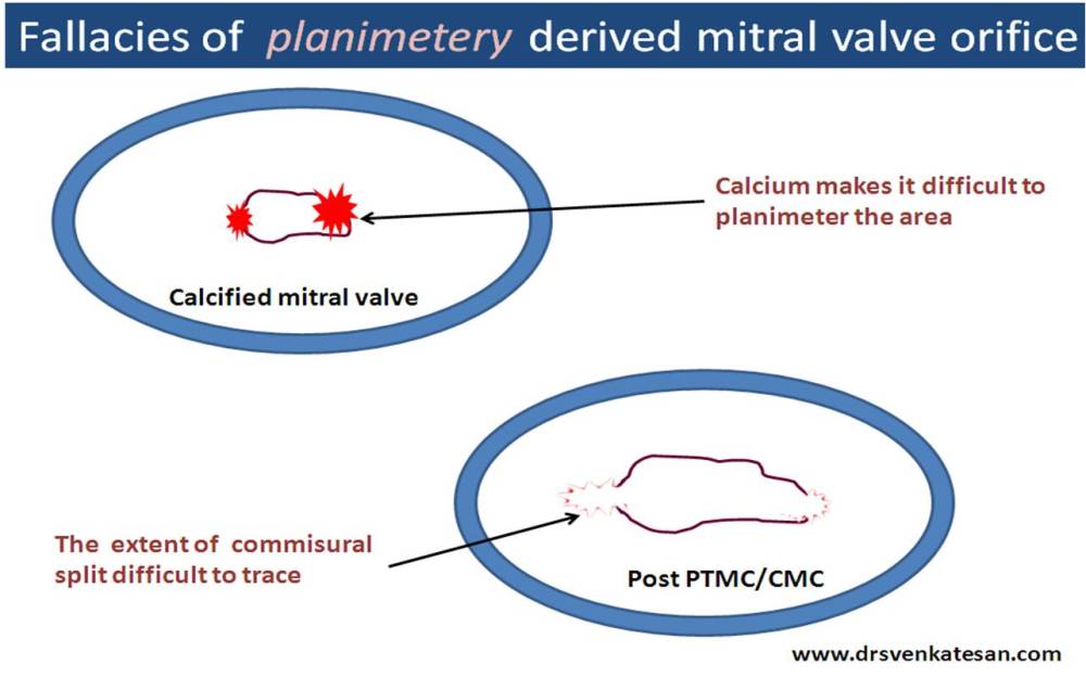mitral valve area by planimetery | Dr.S.Venkatesan MD
