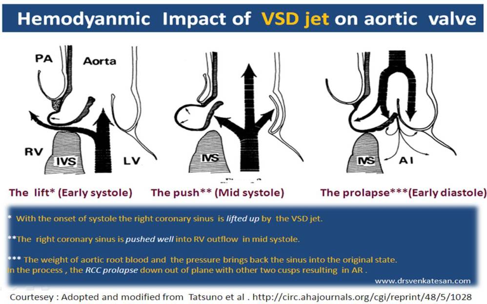 vsd and aortic regurgitation | Dr.S.Venkatesan MD