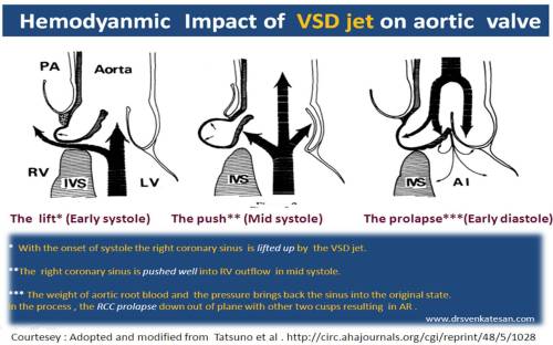 Clinical and hemodynamic tips to diagnose VSD and Aortic regurgitation ...