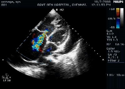 ra rv dilatation | Dr.S.Venkatesan MD