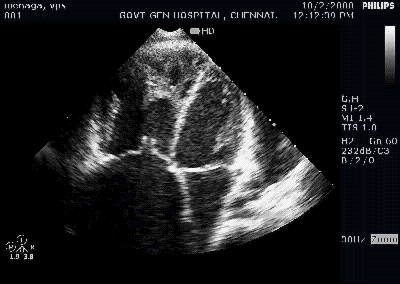 stunning echocardiography | Dr.S.Venkatesan MD