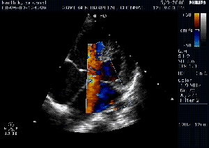 An ostium primum ASD + Inlet VSD = AV canal defect ! | Dr.S.Venkatesan MD