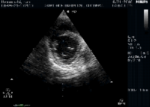 bi atrial enlargement | Dr.S.Venkatesan MD