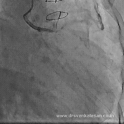 left anterior descending artery | Dr.S.Venkatesan MD
